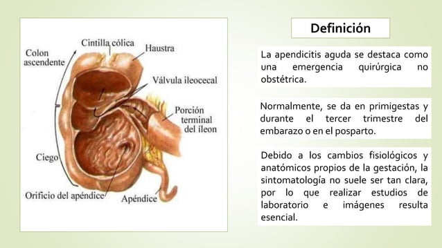 Apendicitis aguda, Obstrucción intestinal en el embarazo. (1) (1).pptx