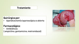Apendicitis aguda, Obstrucción intestinal en el embarazo. (1) (1).pptx