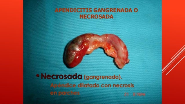 Apendicitis aguda pre y post operatorio. plastron flemon masa apendic…