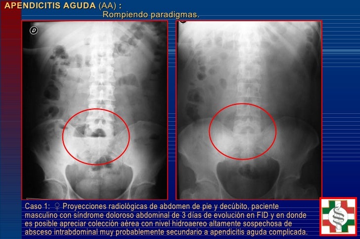 Apendicitis aguda rompiendo paradigmas