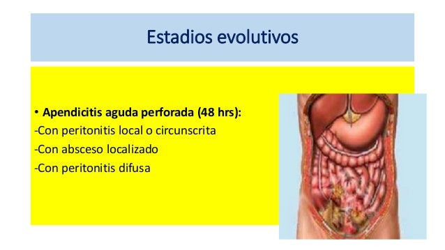 Apendicitis aguda