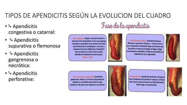 APENDICITIS aguda anatomia y masaleale.pptx