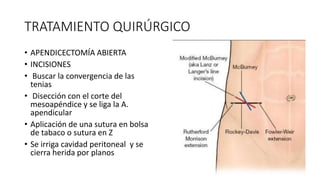 Apendicitis cirugía | PPTX