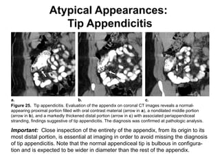 Apendicitis CT atypical Radiologia e Imagen | PPTX