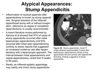 Apendicitis CT atypical Radiologia e Imagen | PPTX