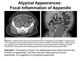 Apendicitis CT atypical Radiologia e Imagen | PPTX