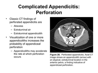 Apendicitis CT atypical Radiologia e Imagen | PPTX