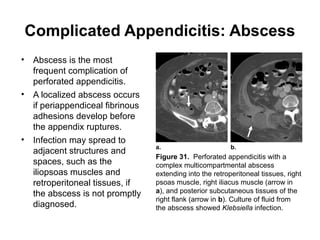 Apendicitis CT atypical Radiologia e Imagen | PPTX