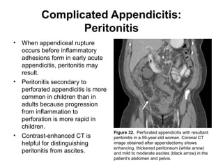 Apendicitis CT atypical Radiologia e Imagen | PPTX