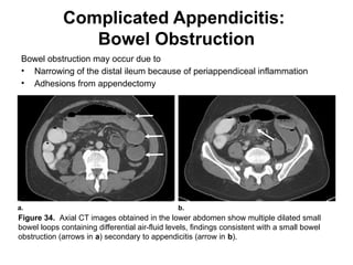 Apendicitis CT atypical Radiologia e Imagen | PPTX
