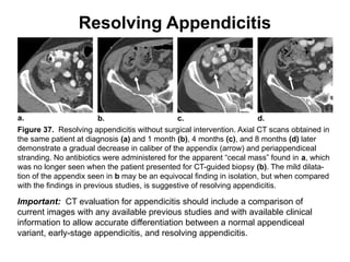 Apendicitis CT atypical Radiologia e Imagen | PPTX