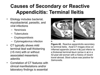Apendicitis CT atypical Radiologia e Imagen | PPTX