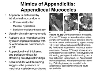 Apendicitis CT atypical Radiologia e Imagen | PPTX