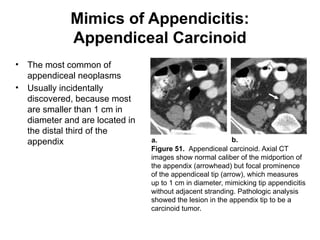 Apendicitis CT atypical Radiologia e Imagen | PPTX