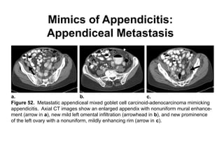Apendicitis CT atypical Radiologia e Imagen | PPTX