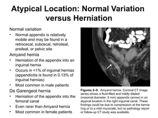 Apendicitis CT atypical Radiologia e Imagen | PPTX