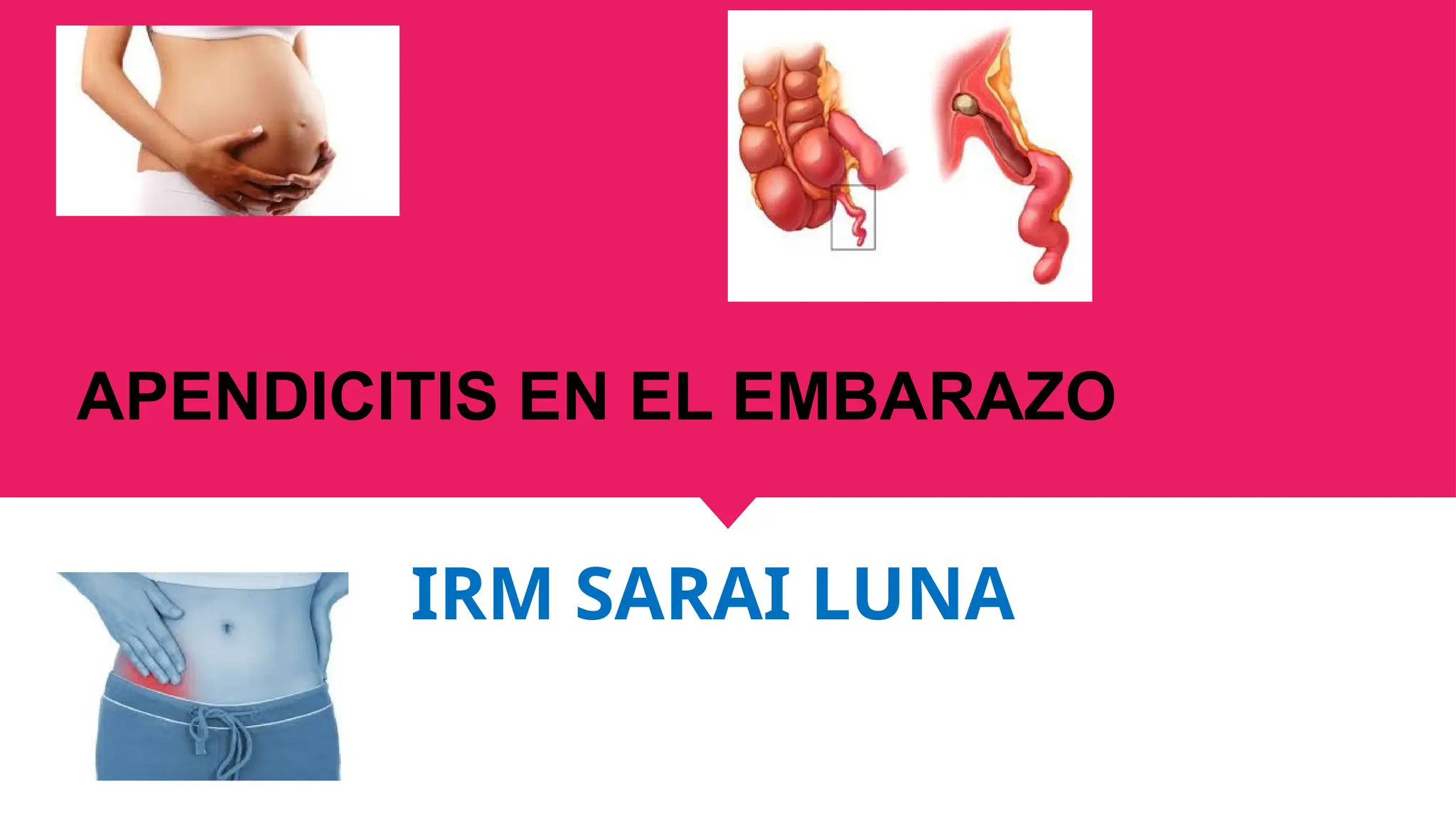 apendicitis en el embarazo tratamiento.pptx