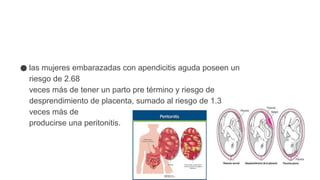 apendicitis en el embarazo tratamiento.pptx