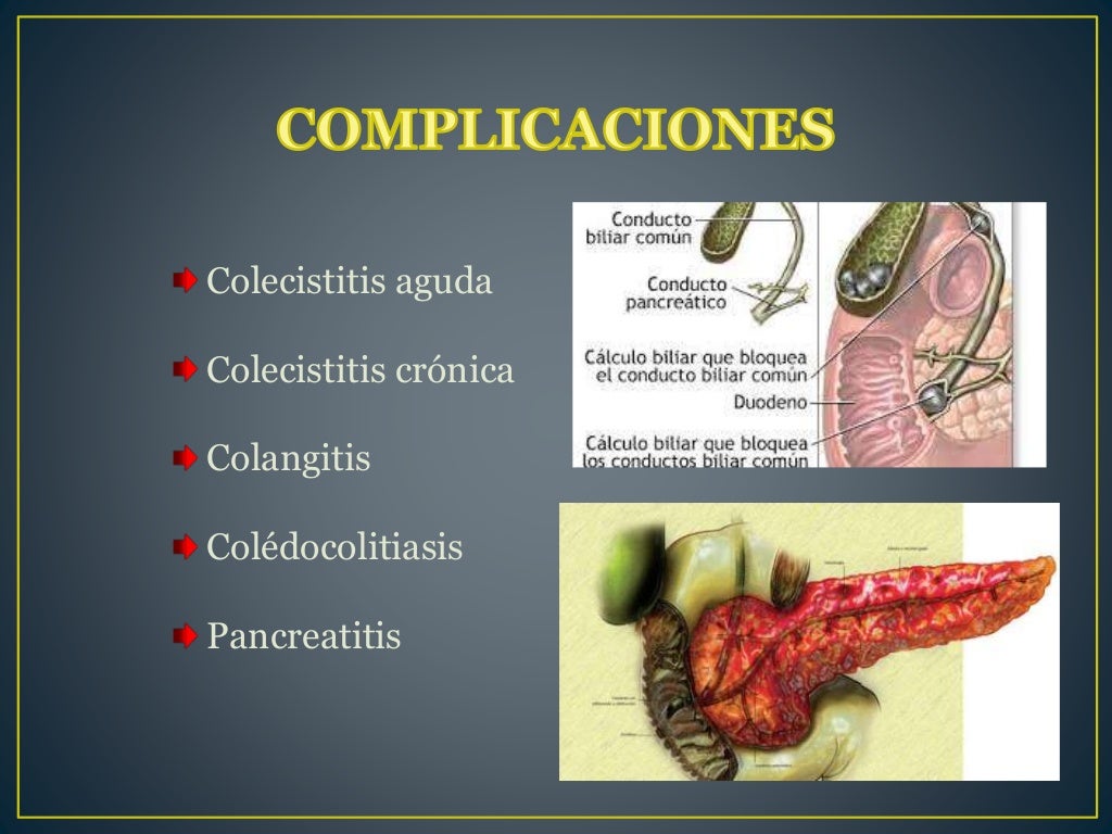 APENDICITIS Y COLELITIASIS