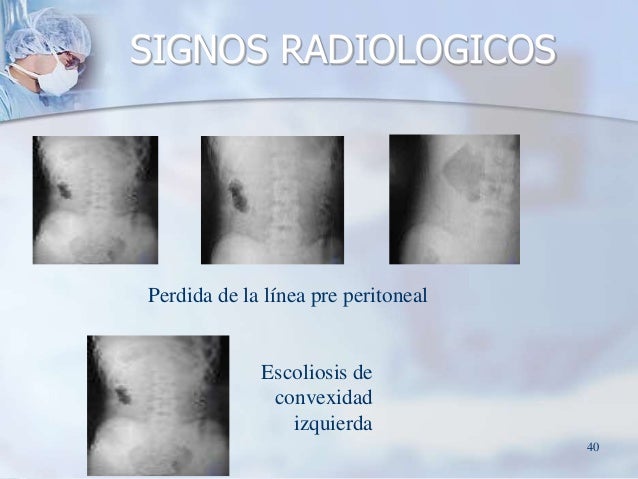 Apendicitis Aguda : Manejo y Técnica quirurgica