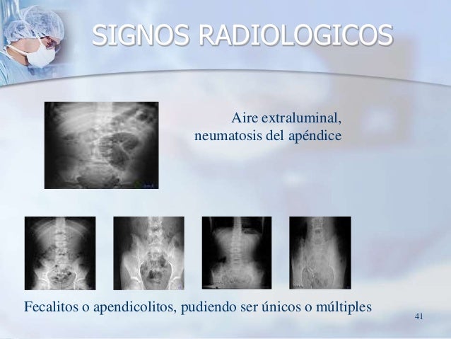 Apendicitis Aguda : Manejo y Técnica quirurgica