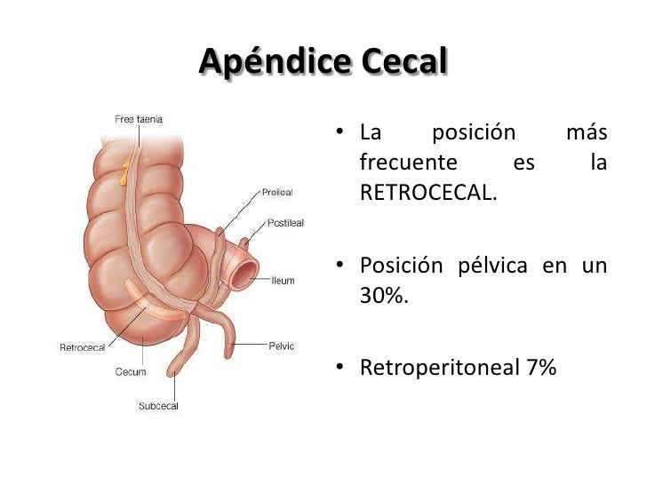 Apendicitis