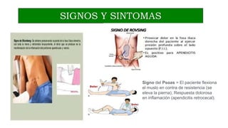 APENDICITIS pptx.pptx