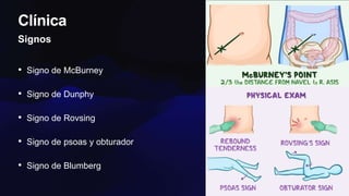 Apendicitis | PPTX