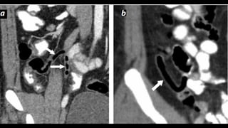 IMAGENOLOGIA APENDICITIS AGUDA POR US Y TAC | PPTX