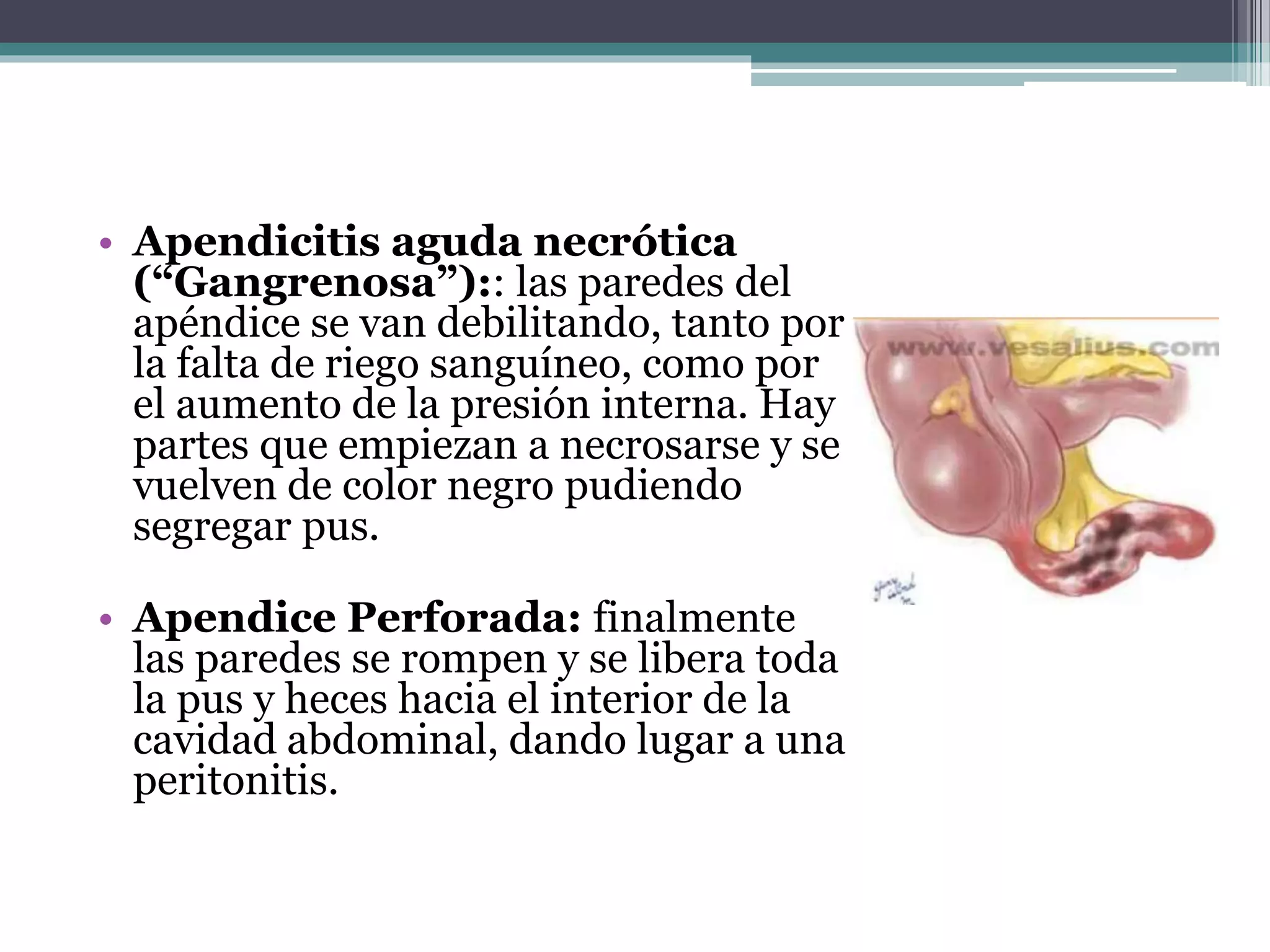 Apendicitis y apendicectomía | PPTX