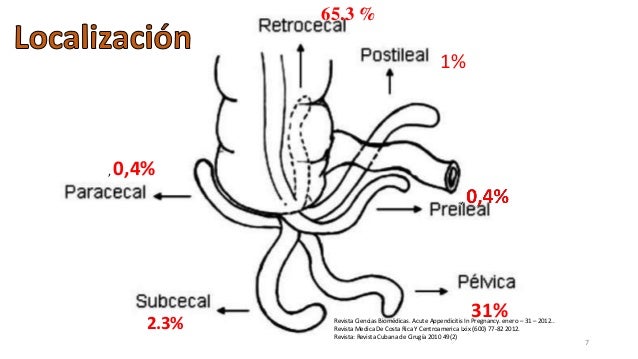 Apendicitis y Embarazo