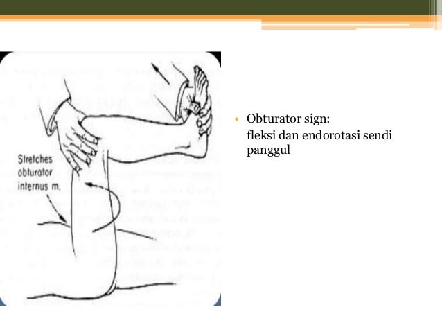 Apendisitis akut & kronik