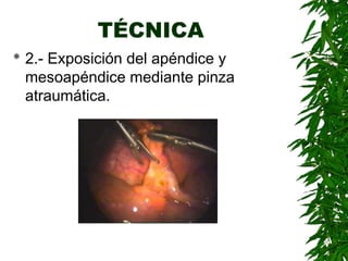 apendicectomia tecnica por laparoscopia.ppt
