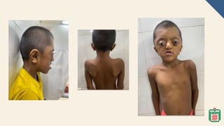 Apert Syndrome | PPTX