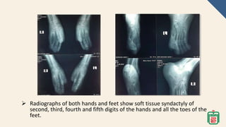 Apert Syndrome | PPTX