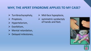 Apert Syndrome | PPTX