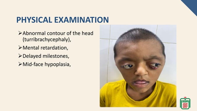 Apert Syndrome | PPTX | Eye and Vision Conditions | Diseases and Conditions