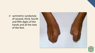 Apert Syndrome | PPTX