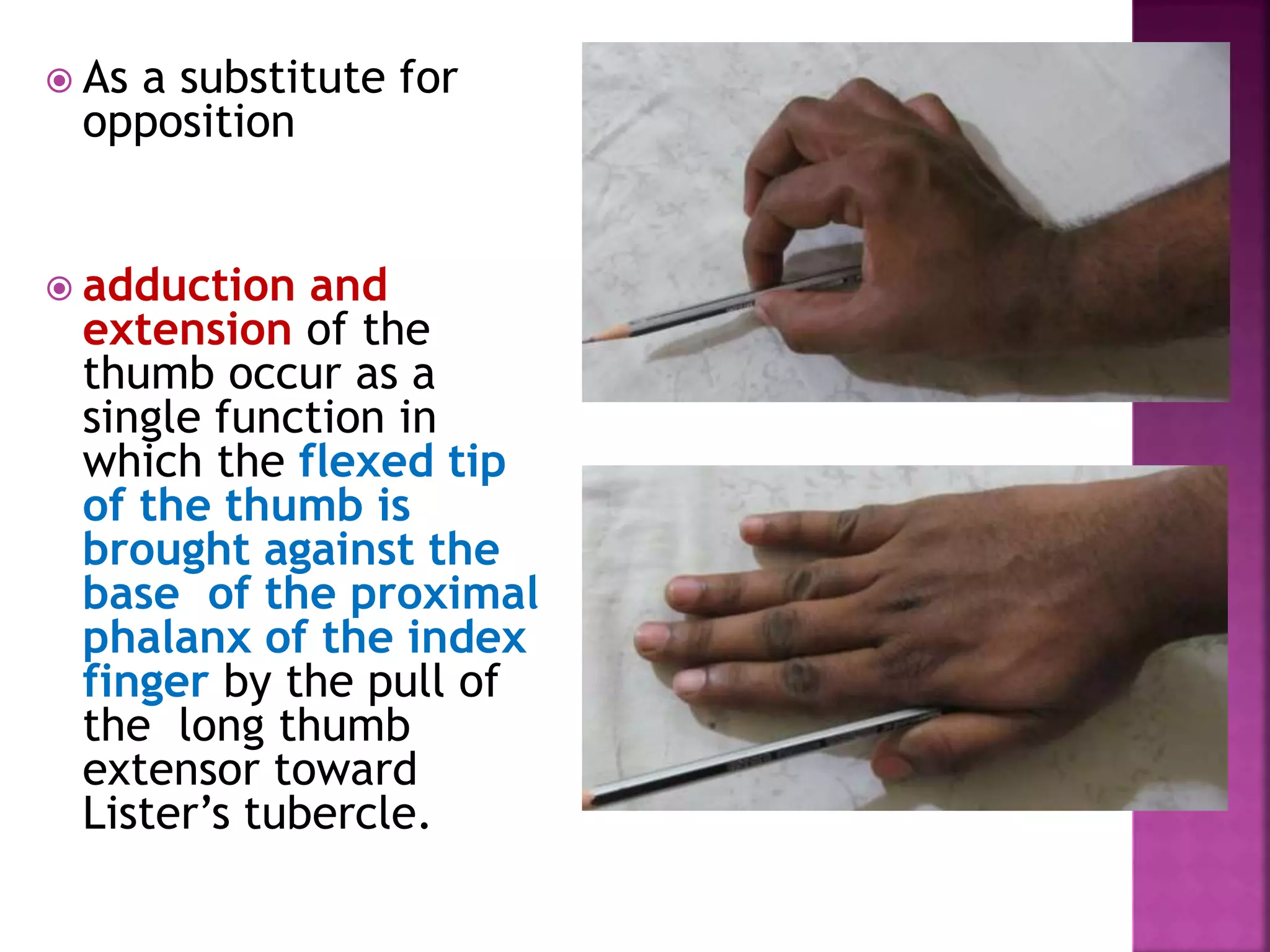 Ape thumb deformity to publish | PPTX