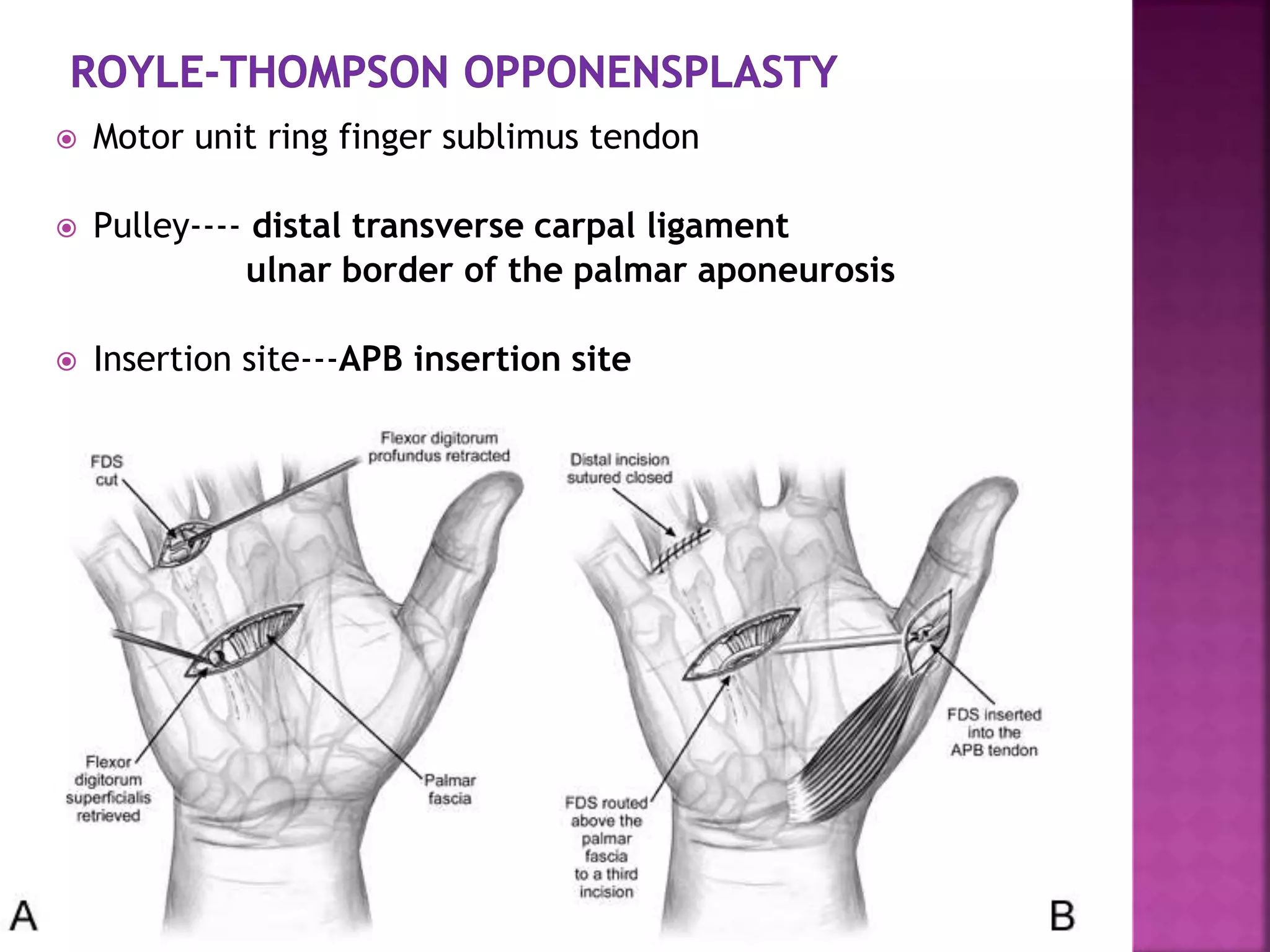 Ape thumb deformity to publish | PPTX