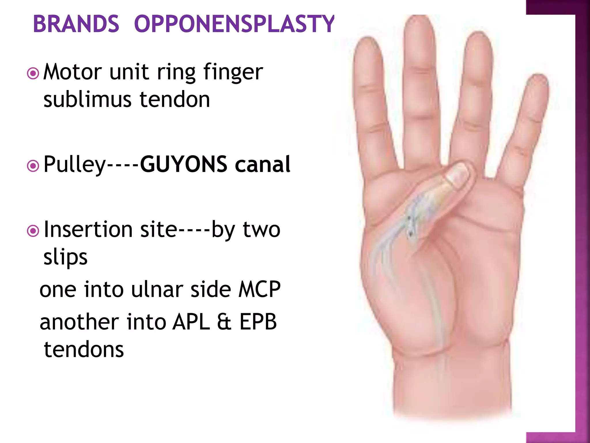 Ape thumb deformity to publish | PPTX