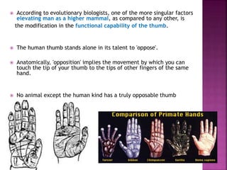 Ape Hand Deformity
