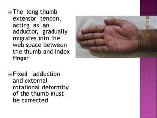 Thumb Extension Deformity