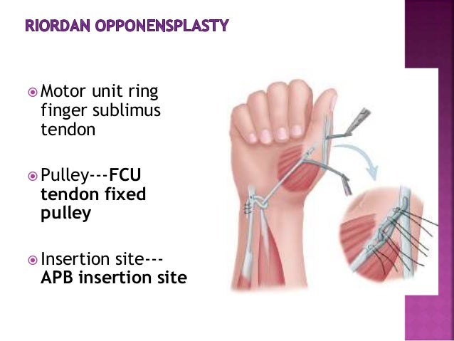 Ape thumb deformity to publish