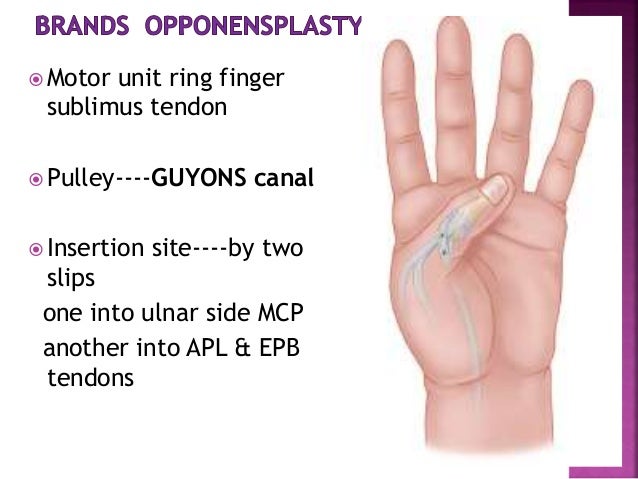 Ape thumb deformity to publish