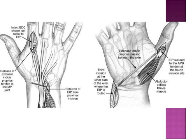 Ape thumb deformity to publish