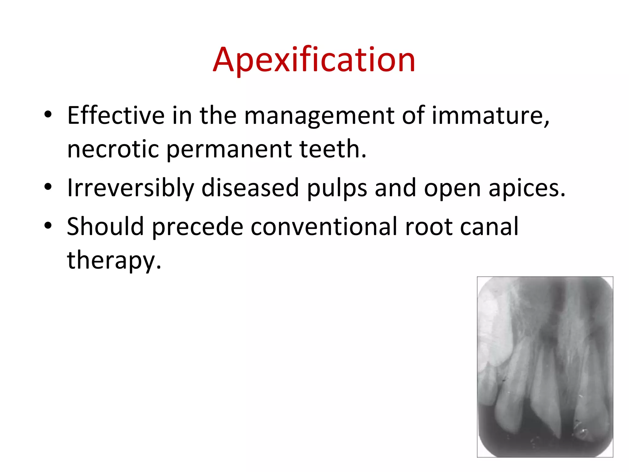 Apexification | PPTX
