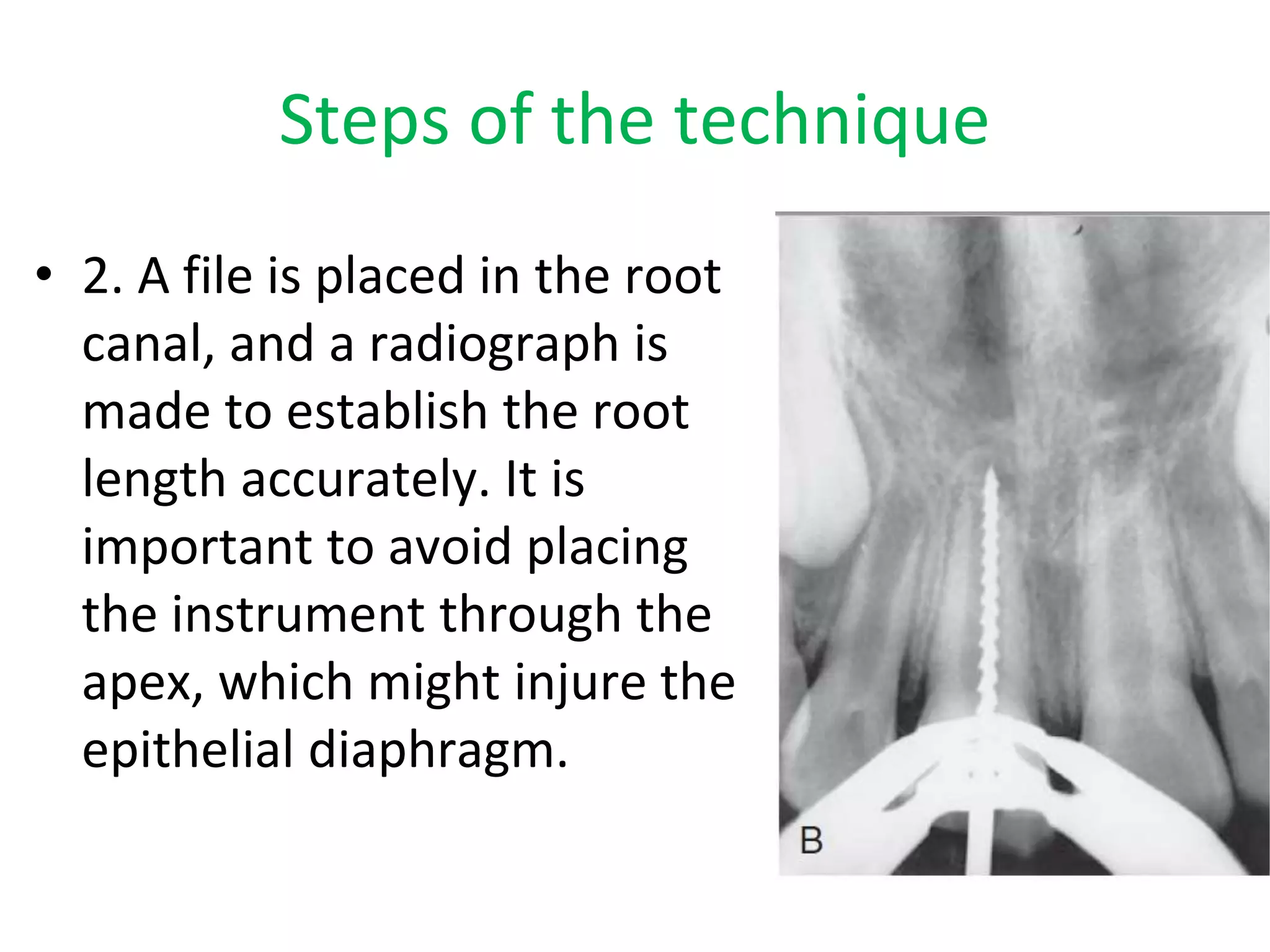 Apexification | PPTX