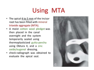 Apexification | PPTX