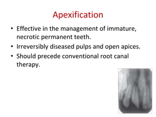 Apexification | PPTX